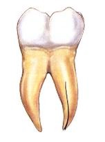 Fractura de radacina | Medici-Stomatologi.ro