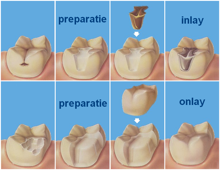 Incrustatii fizionomice | Medici-Stomatologi.ro