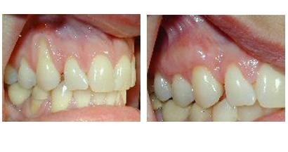 Grefa gingivala | Medici-Stomatologi.ro